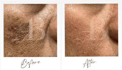 Pigmentation Treatment Dr Abby Clinic