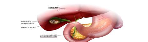 Choledocholithiasis Presents A Significant Challenge And Carries A