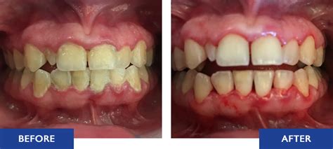 Teeth Deep Cleaning Before And After