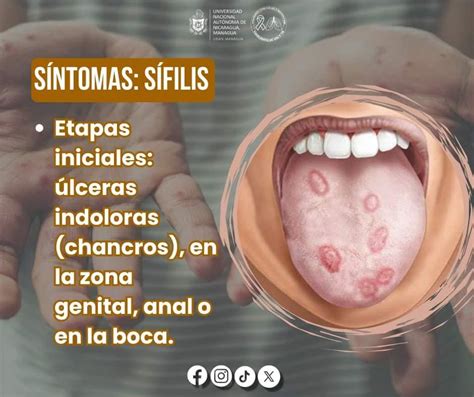 🔍 ¿conoces Los Síntomas De La Sífilis Es Importante Estar Informado