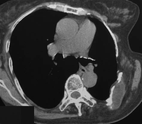 Scapulothoracic Bursitis Diagnosis At Greta Pickard Blog
