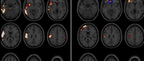 Robotised And Neuronavigated Transcranial Magnetic Stimulation With