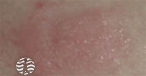 Positive Patch Test To Formaldehyde Image