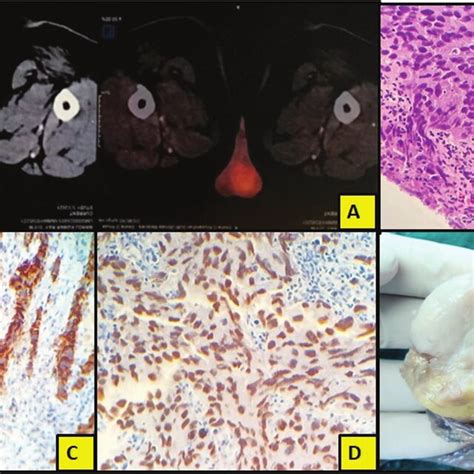A Positron Emission Tomography Scan Showing Increased Tracer Uptake Download Scientific