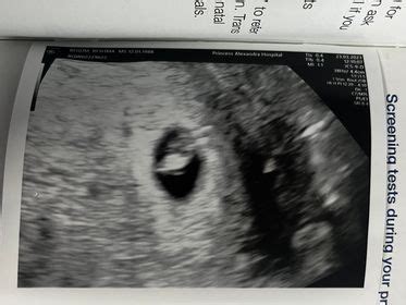 Testimonial Weeks Days Female Sterilization Reversals
