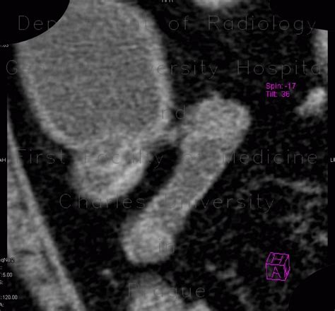 Radiology Case Crohns Disease Ileocecal Resection Stenosis Of