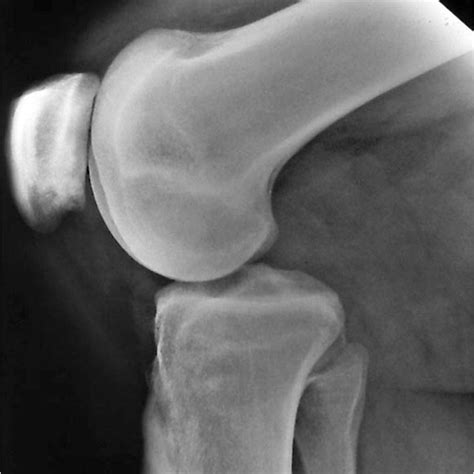 A Lateral Radiograph Of Anterolateral Knee Dislocation B Ap Radiograph