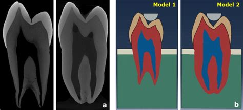 Biaxial Flexure Strength Determination Of Endodontically Accessed