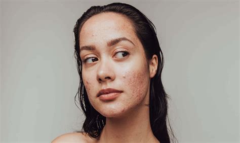Beautiful People With Acne Scars