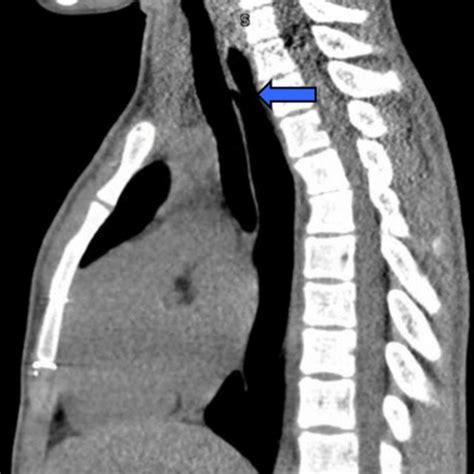 Five Types Of Tef Type A Isolated Ea Type B Ea With Proximal Tef