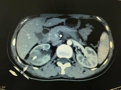 右肾囊肿感染伴脓肿形成 医联
