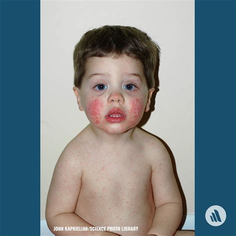 Erythema Infectiosum