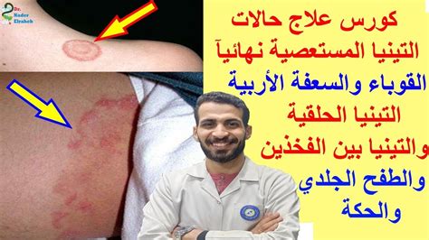 علاج الطفح الجلدي نهائيآ و الحكة الشديدة بين الفخذين و فطريات القدم و