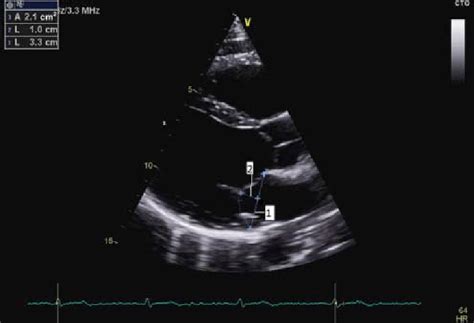 Parasternal Long Axis View Demonstrating Measurements Of The Mitral Download Scientific Diagram