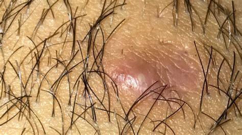 Routine For Maintenance Of Ingrown Hair Cyst Pubic Area