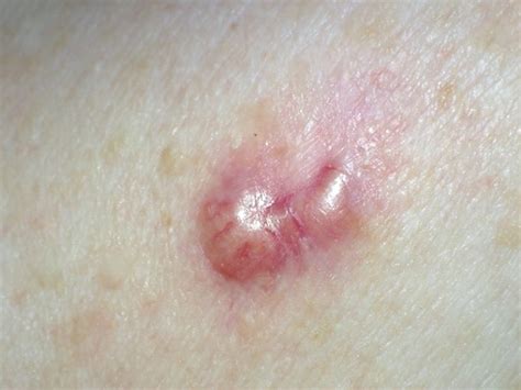 Nodular Bcc Understanding The Importance Of Daily Imaging In The