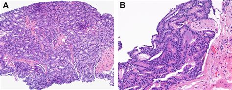 Cribriform Lesions Of The Prostate Gland Surgical Pathology Clinics