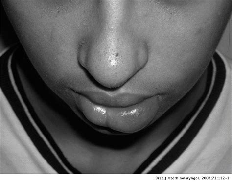 Cheilitis Granulomatosa Associated With Melkersson Rosenthal Syndrome