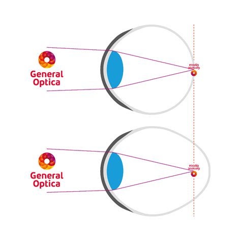 Miopía Infantil Características Causas Y Tratamientos General Optica