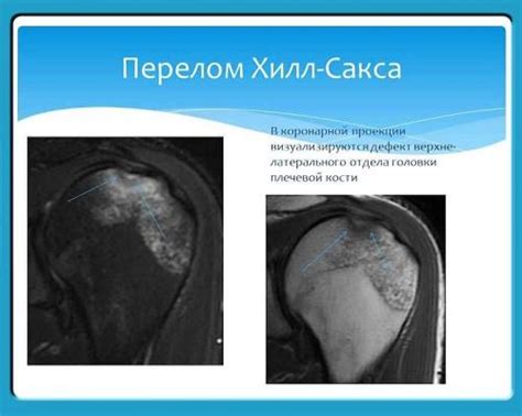 Повреждение Хилл-Сакса плечевого сустава. Классификация | Школа красоты
