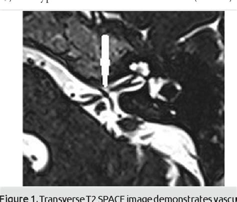 Figure 1 From Can Anatomical Variations Of Aica Loop Be A Cause Of Hearing Loss Which Can Affect