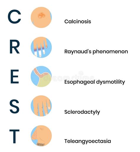CREST Syndrome Icons System Sclerosis Symptoms Stock Vector Illustration Of Medical Syndrome