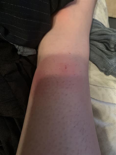 Are These Bed Bug Bites R Bugbites