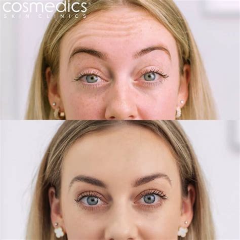 Botox Before And After Forehead