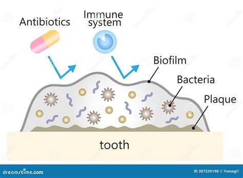 Dental Biofilm Removal Cute Character Illustration Bacteria And Plaque Attachment On Tooth