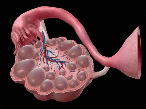 What Is Polycystic Ovary Syndrome