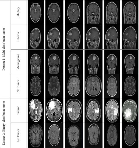 Figure 3 From The Deep Learning Model For The Examination Of Brain