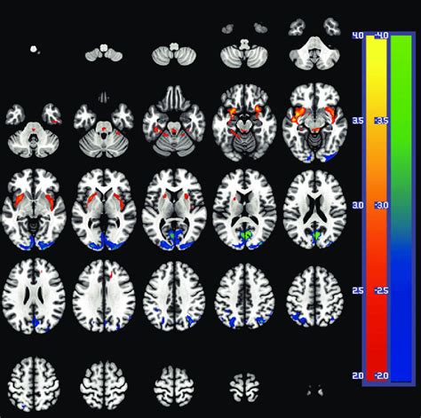 Spatial Covariance Pattern Of Regional Cerebral Metabolic Rate Of Download Scientific Diagram