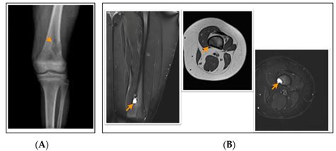 A 12 Year Old Patient With A Fibrous Cortical Defect Around The Knee Download Scientific