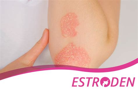 Scaly Skin Symptoms Causes And Natural Treatments Estroden