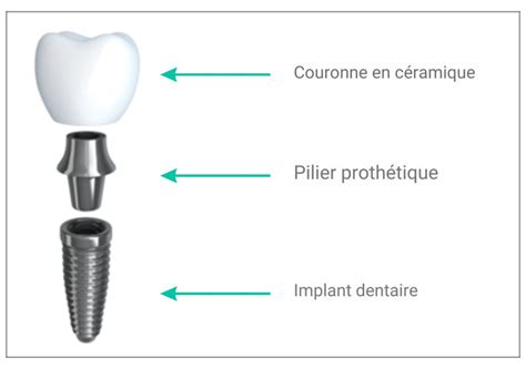 Implant Dentaire Ou Dent Sur Pivot Comment Les Différencier