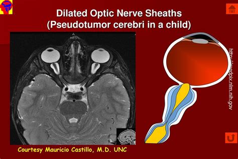 Orbit Lesions Differential Diagnosis By Location Ppt Download