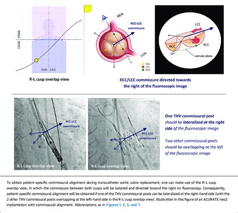 Implantation Technique For Obtaining Patient Specific Commissural Alignment Download