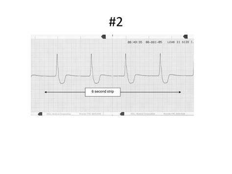 Ppt Ecg Practice Strips Learn To Interpret Cardiac Tracings Easily