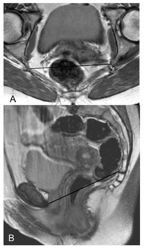 Comparison Of Bony Dimensions At The Level Of The Pelvic Floor In Women