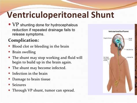 Shunt Vp Infection Vp Shunt Procédure Types Coûts Et Risques Fqda