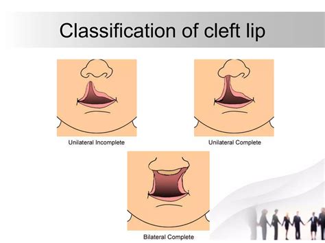 Cleft Lip And Palate Ppt