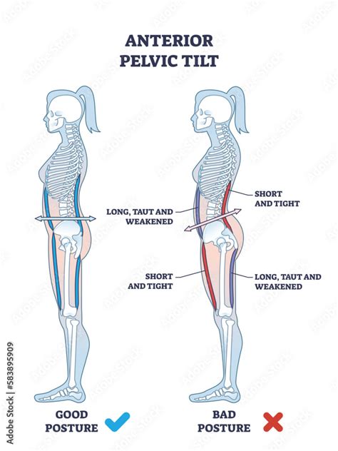 Naklejka Anterior Pelvic Tilt Or Apt As Pelvis Abnormal Posture Outline