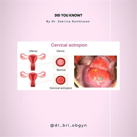 Cervical Erosion Causes