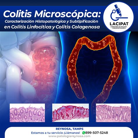 Lacipat 🧫 Colitis Microscópica Caracterización Histopatológica Y