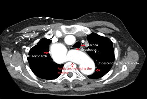 Aortic Arch Branches Radiology