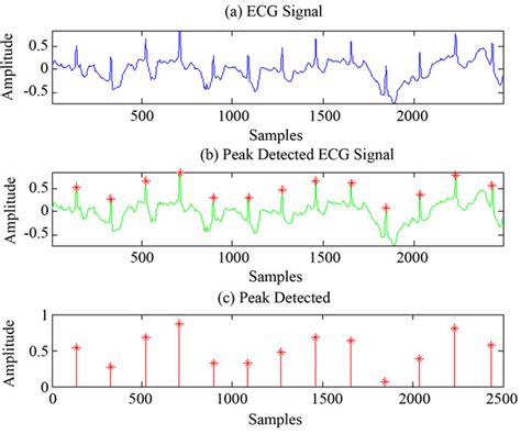 Wavelet Diagnosis Of Ecg Signals With Kaiser Based Noise Diminution