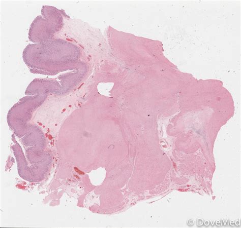 Leiomyoma Of The Genitourinary System