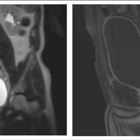 Flexible Cystoscopy Revealed Prostatic Hyperplasia And A Polypoidal