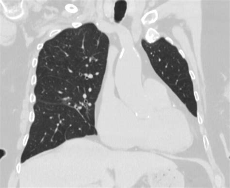 192lu Acute Mycobacterium Complex The Common Vein