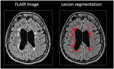 Frontiers Ai Driven Mri Analysis Reveals Brain Atrophy Patterns In Benign Relapsing Remitting